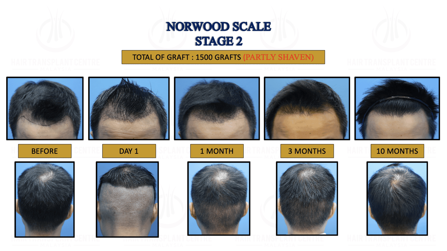 Norwood Stage 2 - Hair Transplant Centre - Malaysia Hair Treatment